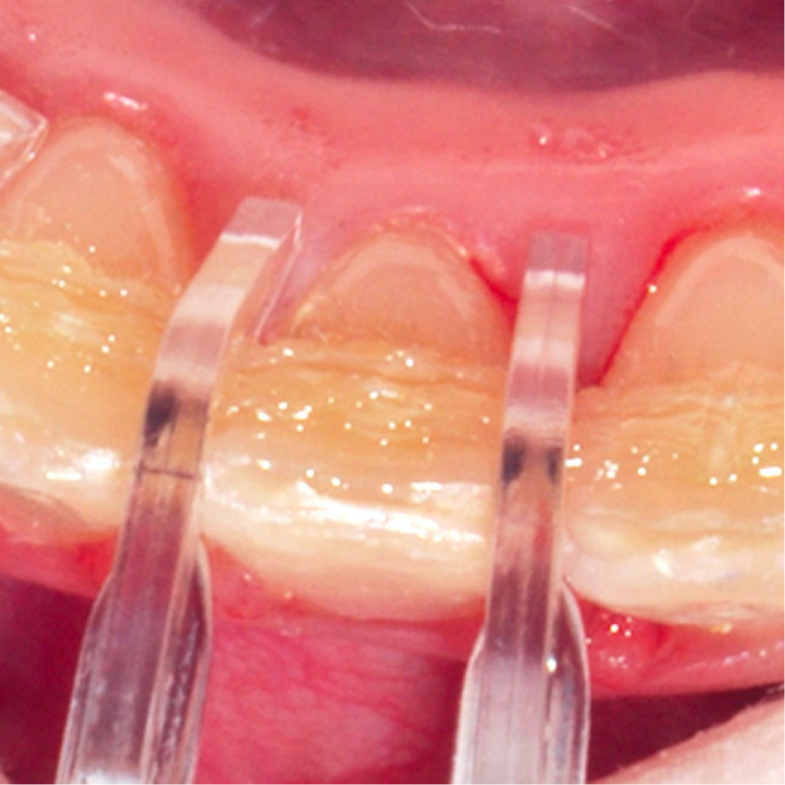 Fiberglas vlakna Fiber Splint One layer - neodent.rs