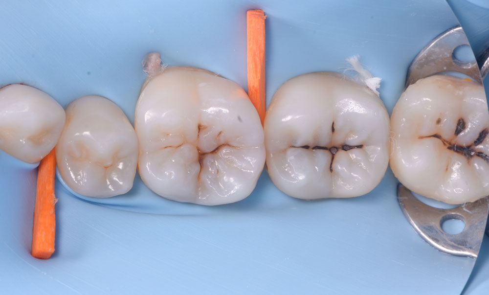 Susedne karijesne lezije na 1. i 2. molaru - neodent.rs